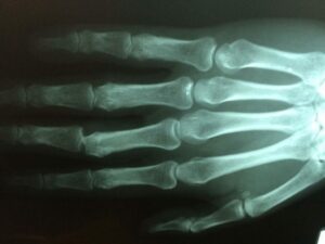 Most Common Broken Bones | Understanding Injury Risks